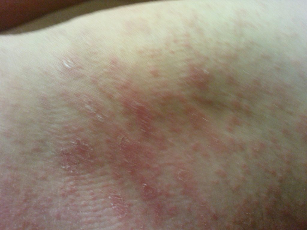 Röschenflechte, machtlose Medizin und ethische Forschungsförderung ...